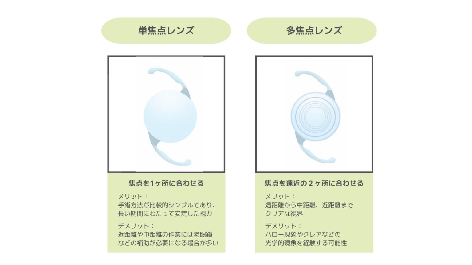 ICLとは？基本からメリット・デメリットまで | 神戸市東灘区・住吉の松原眼科クリニック｜白内障手術、多焦点眼内レンズ、緑内障手術